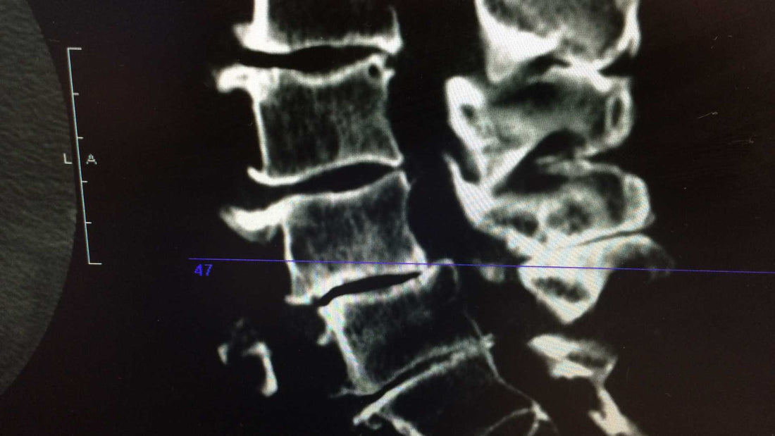 Uncodiscarthrose : qu’est-ce que c’est et comment la soigner