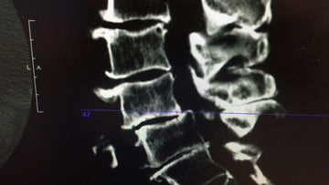 Uncodiscarthrose : qu’est-ce que c’est et comment la soigner