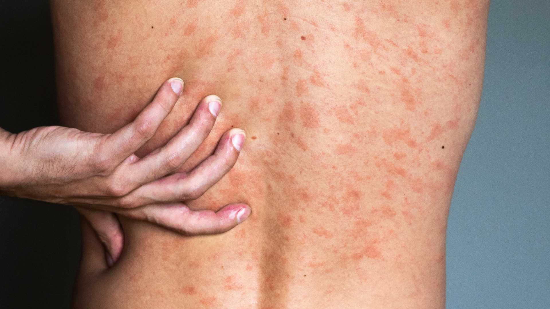 Comment mieux dormir avec de l’urticaire